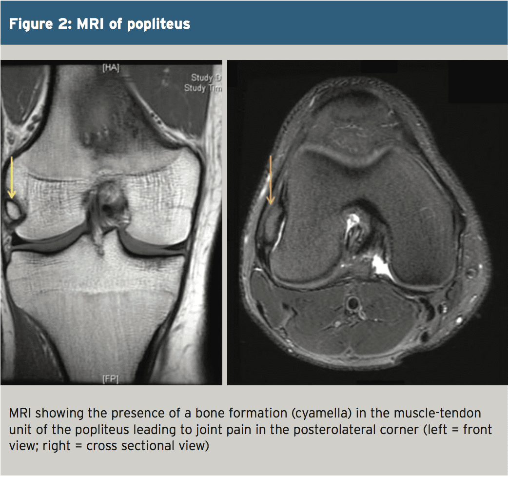 Popliteus Muscle: Assessment & Rehabilitation