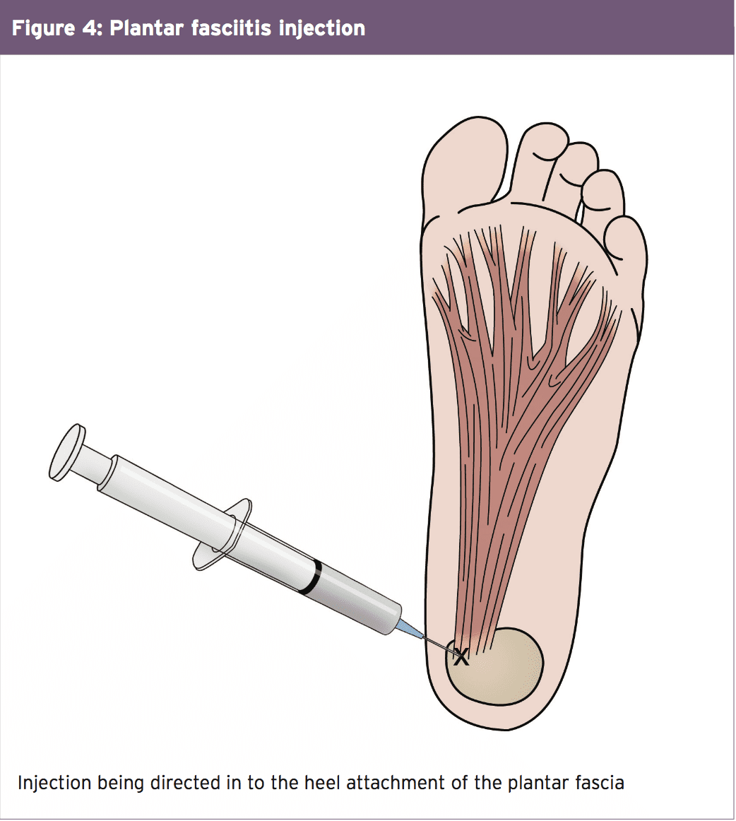 Corticosteroid Injection Therapy: Treatment Options