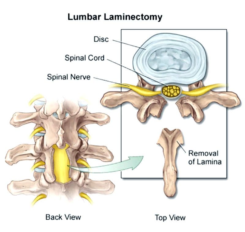 Spinal Decompression Surgery Laminotomy And Laminectomy